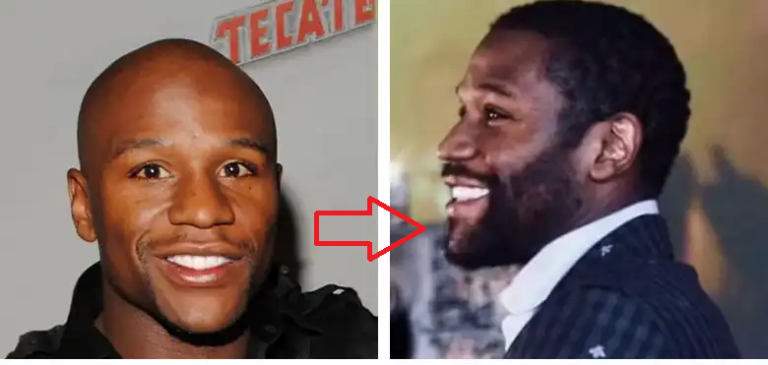 Floyd Mayweather: Hair Transplant & Beard Transplant Journey
