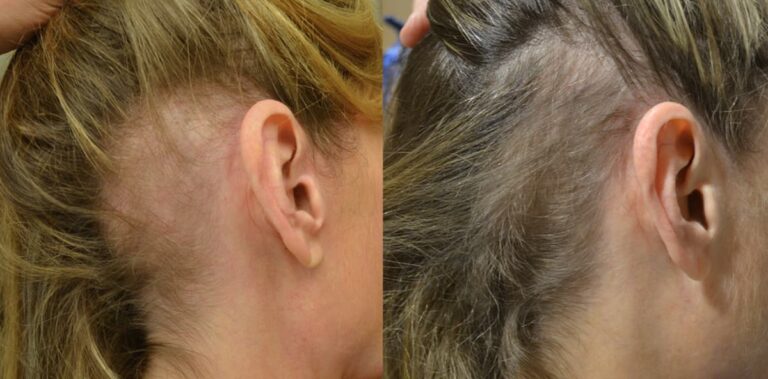 Hair Loss Behind Ears: Causes, Diagnosis, and Treatments. - Kopelman Hair